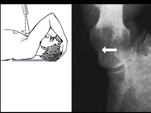 Shoulder Imaging : 네이버 블로그