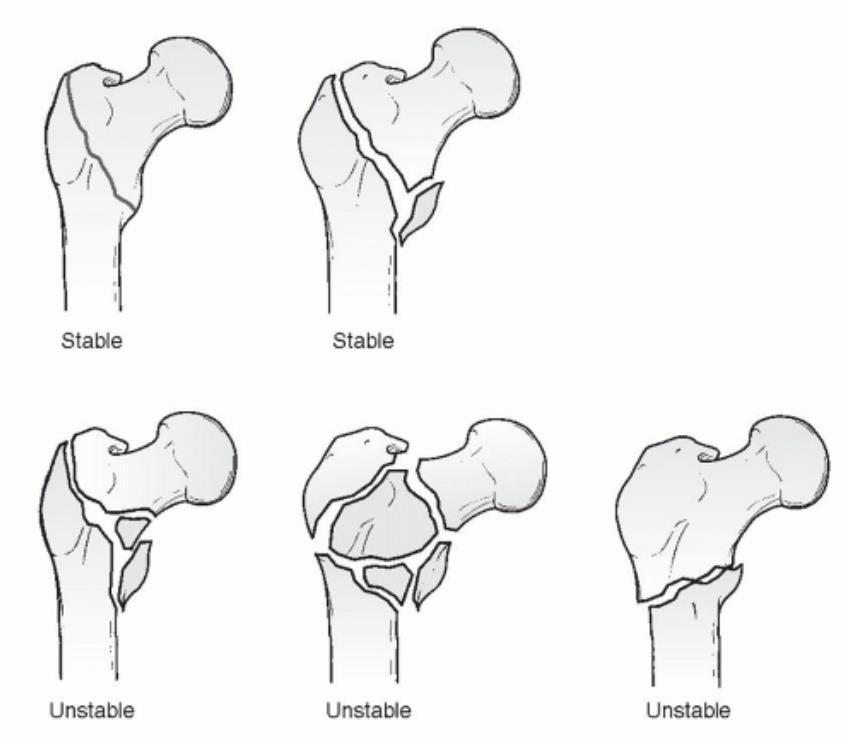 Intertrochanteric Fractures - Trauma - Orthobullets