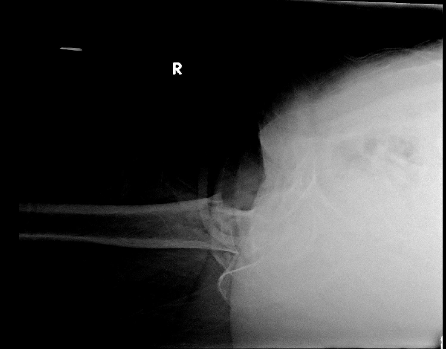 Intertrochanteric Fractures - Trauma - Orthobullets