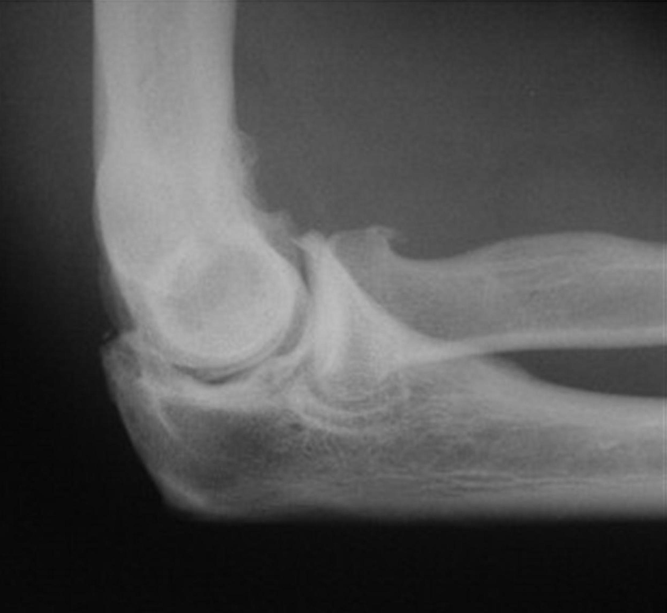 Partial Elbow Arthroplasty - Shoulder & Elbow - Orthobullets