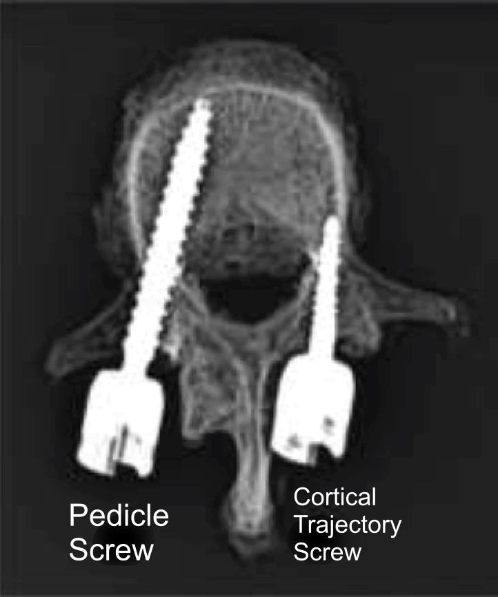 Degenerative Spondylolisthesis - Spine - Orthobullets