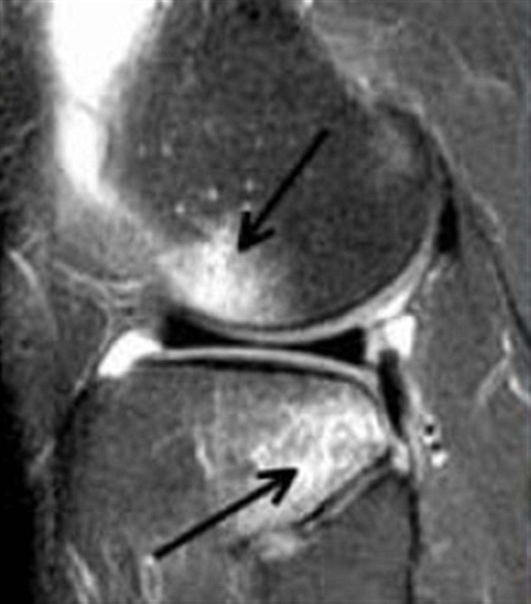 ACL Tear - Knee & Sports - Orthobullets