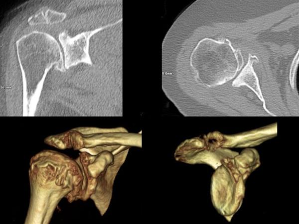 Shoulder Imaging : 네이버 블로그