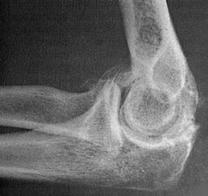 Elbow Arthritis - Shoulder & Elbow - Orthobullets