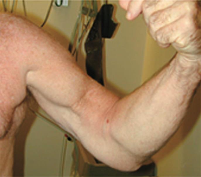 Elbow Physical Exam - Shoulder & Elbow - Orthobullets