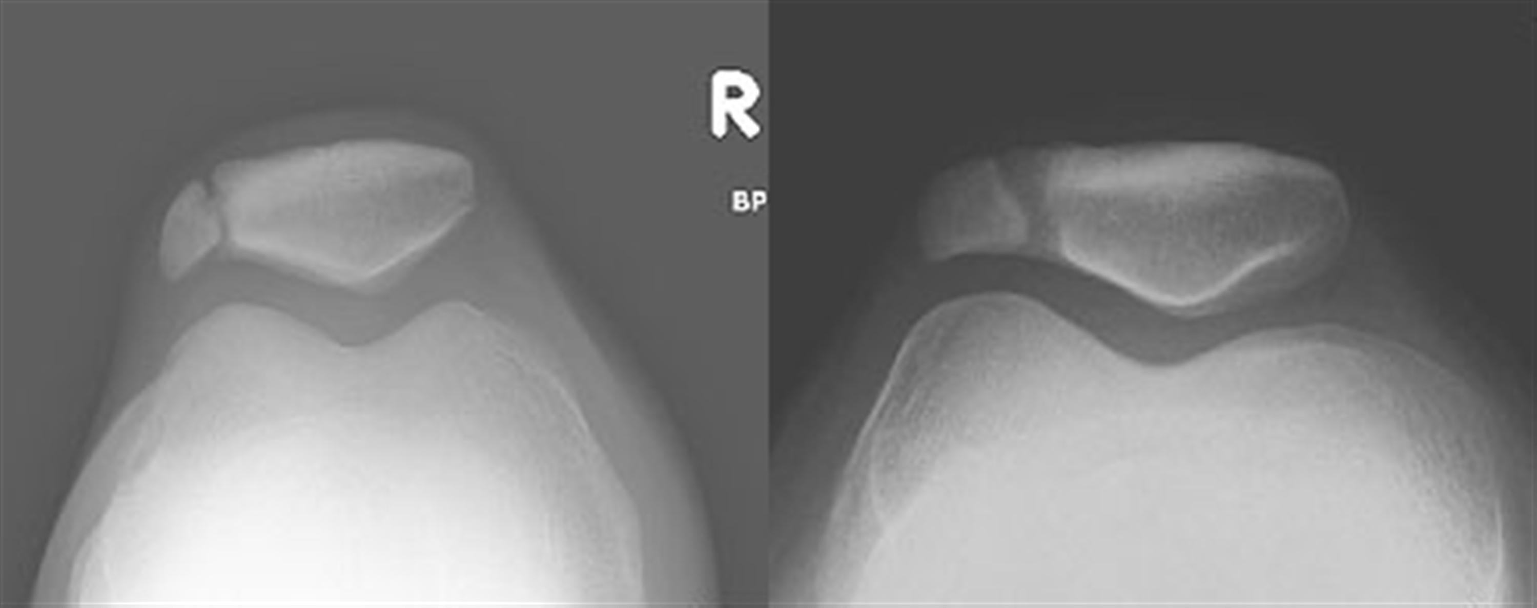 Bipartite Patella - Pediatrics - Orthobullets