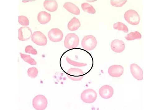 Sickle Cell Anemia - Basic Science - Orthobullets