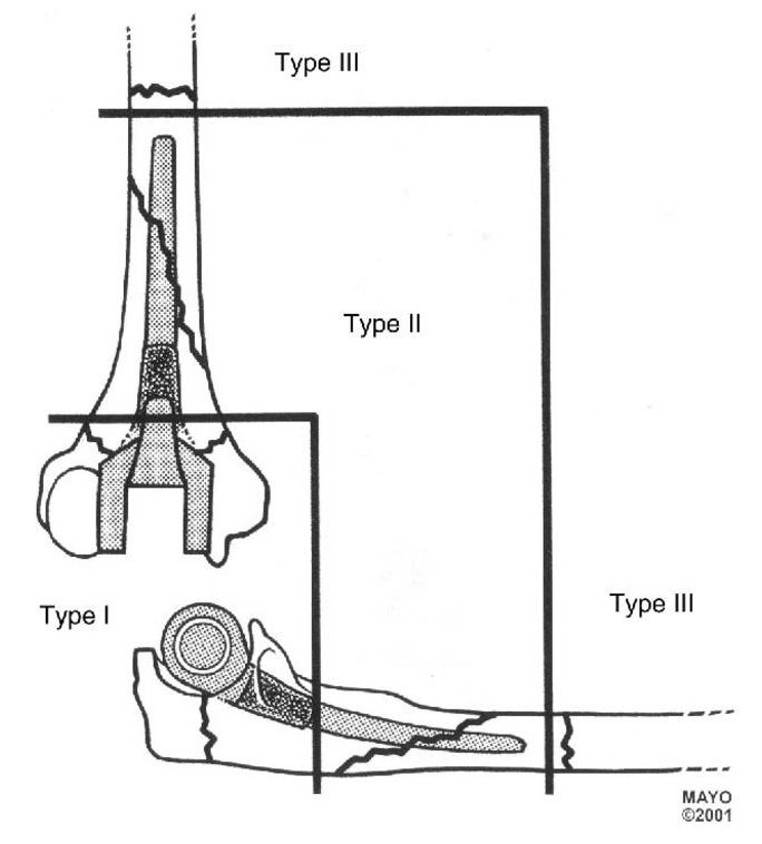 Revision Total Elbow Arthroplasty - Shoulder & Elbow - Orthobullets