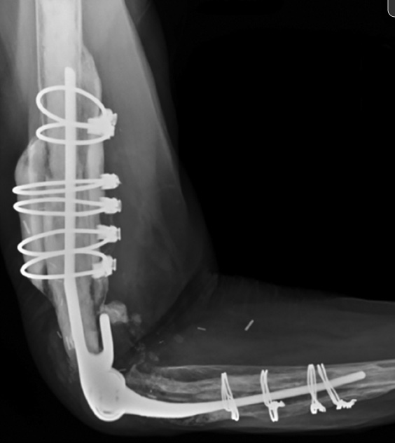 Revision Total Elbow Arthroplasty - Shoulder & Elbow - Orthobullets
