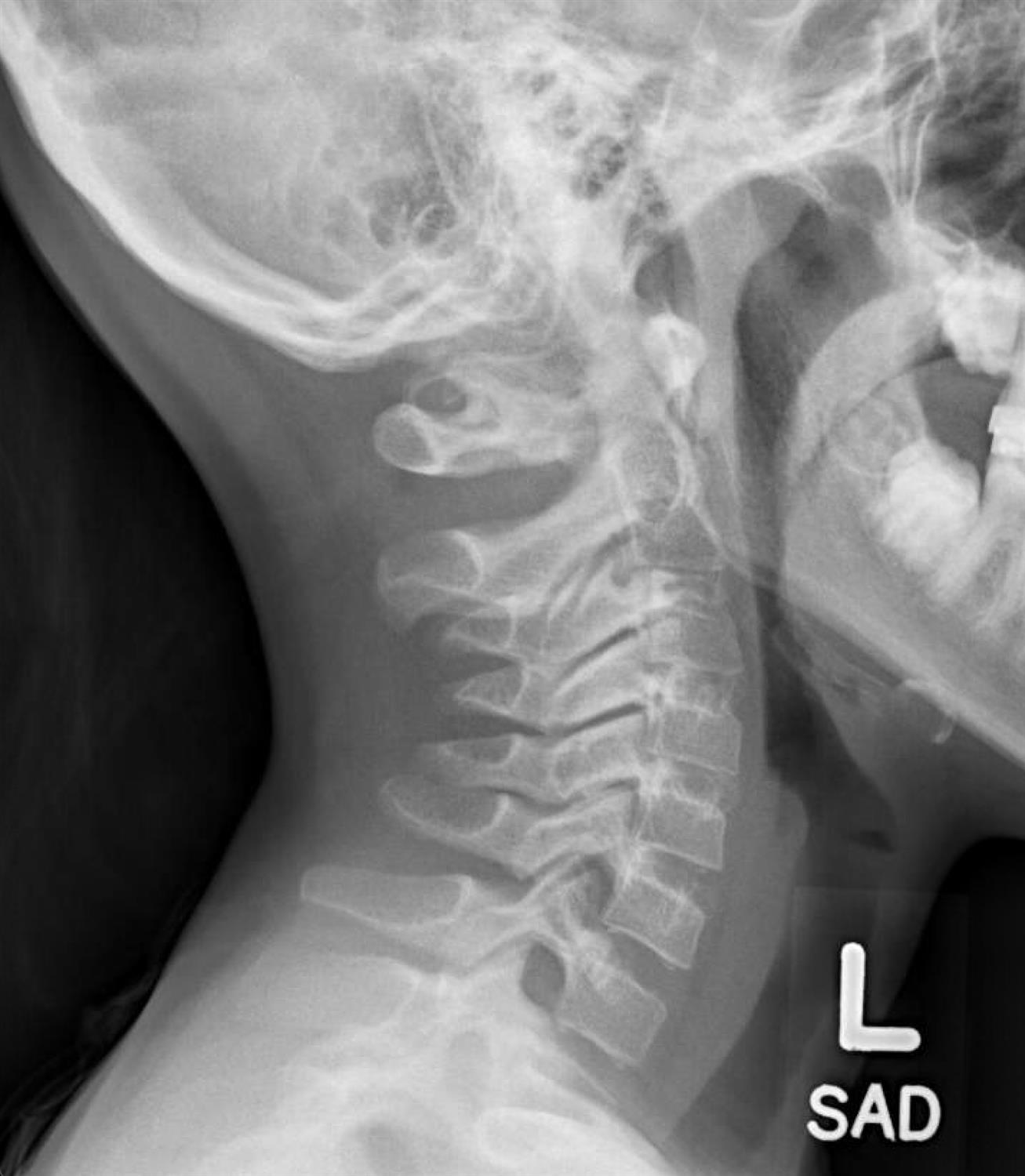 Pediatric Intervertebral Disc Calcification - Spine - Orthobullets
