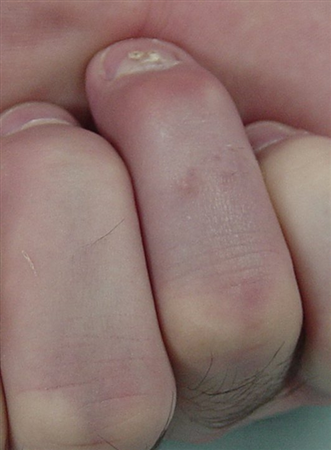 Jersey Finger - Hand - Orthobullets