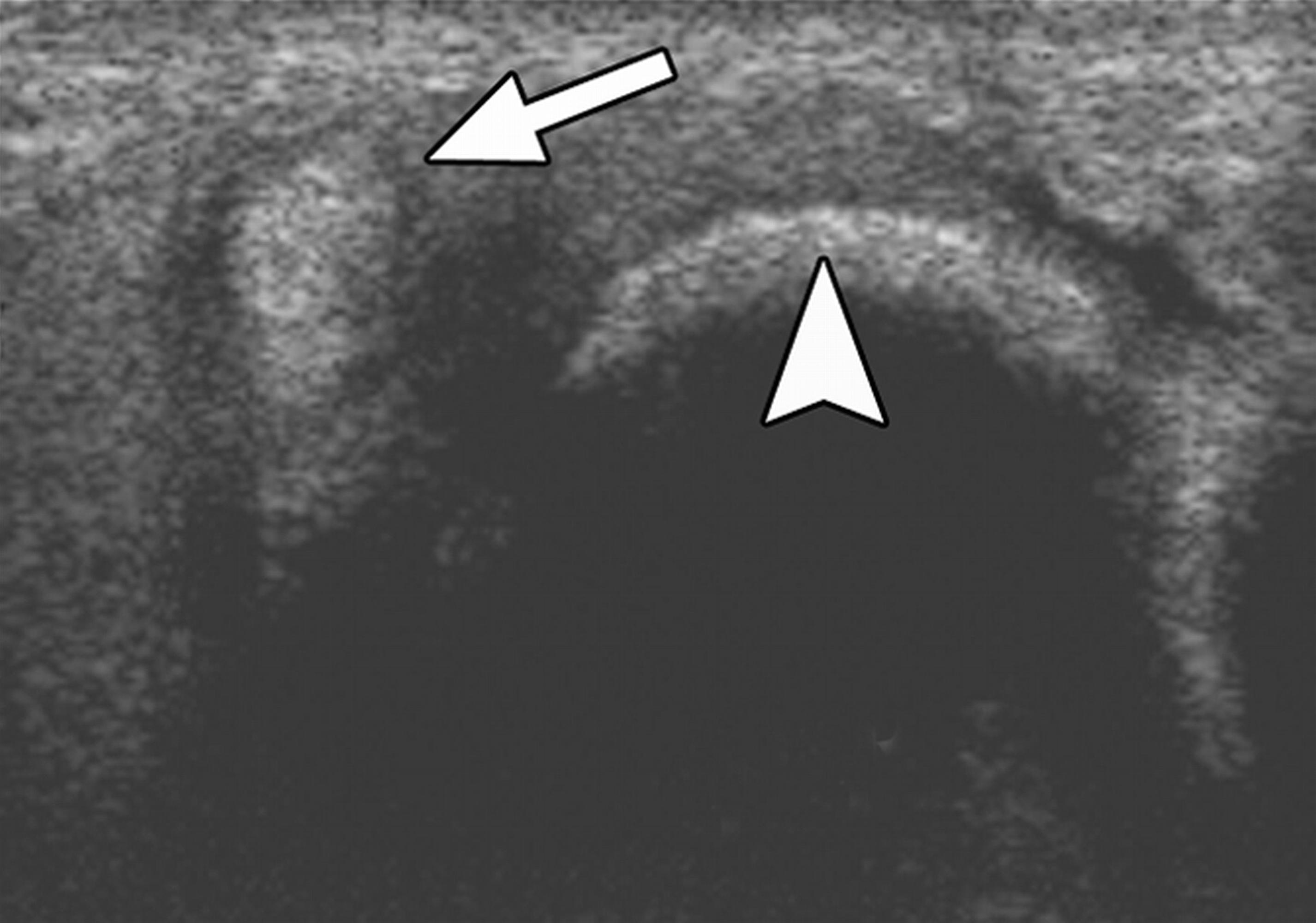 Sagittal Band Rupture (traumatic extensor tendon dislocation) : 네이버 블로그
