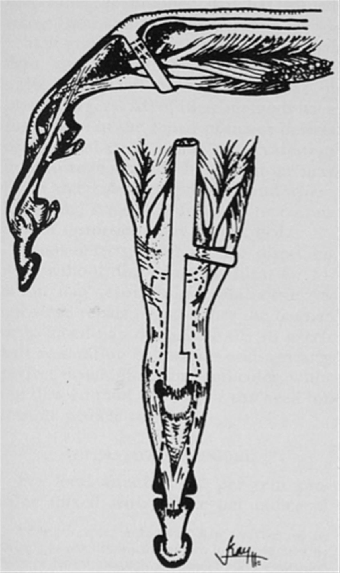 Sagittal Band Rupture (traumatic extensor tendon dislocation) : 네이버 블로그