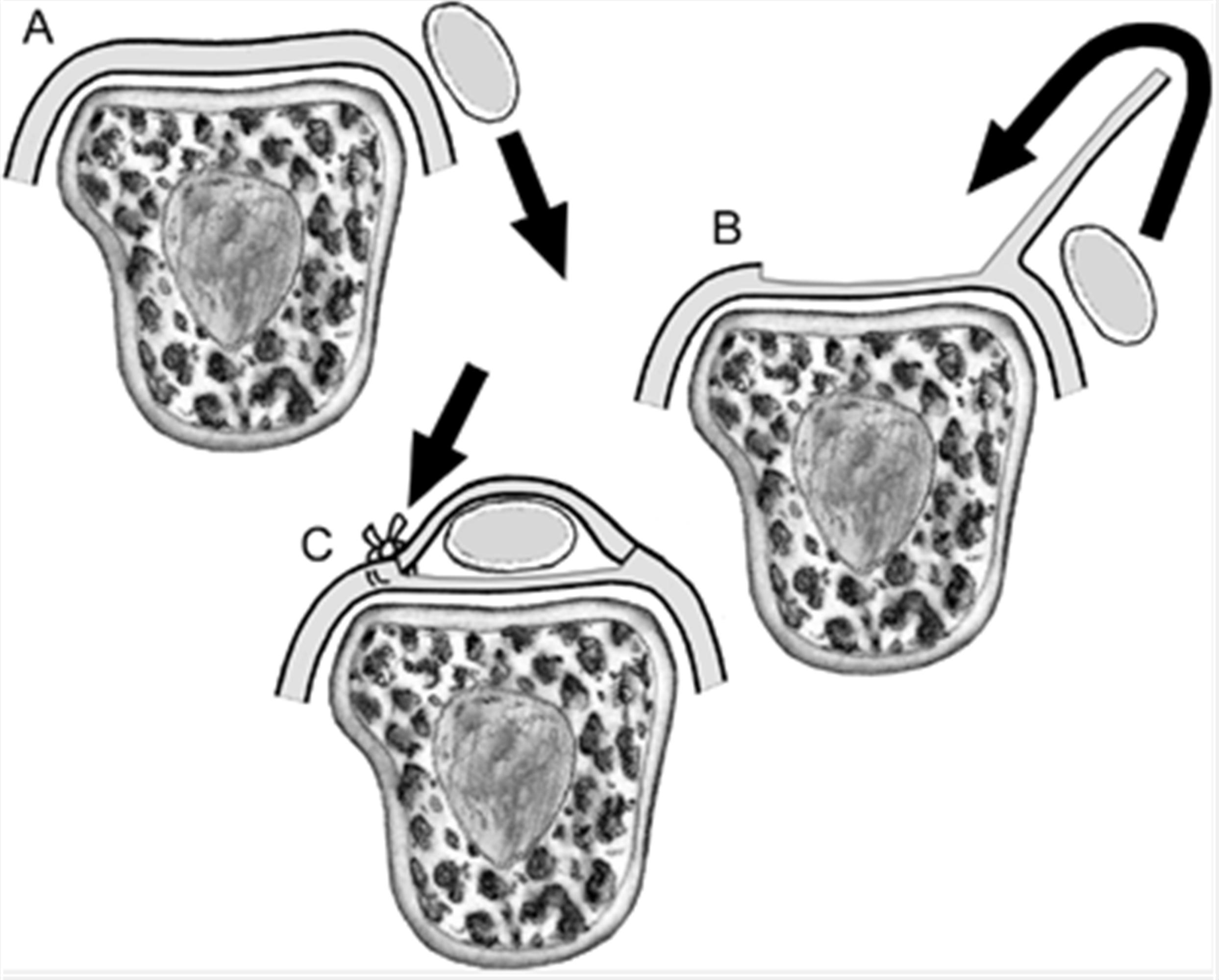 Sagittal Band Rupture (traumatic extensor tendon dislocation) : 네이버 블로그