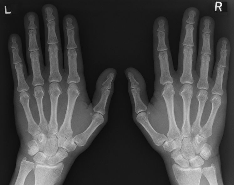 Raynaud's Syndrome - Hand - Orthobullets