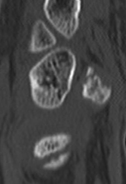 Pisiform Fracture - Hand - Orthobullets