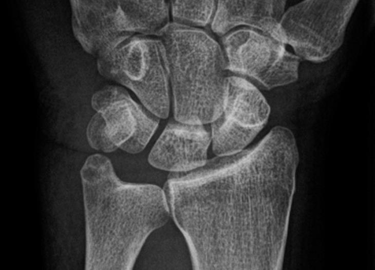 Pisiform Fracture - Hand - Orthobullets