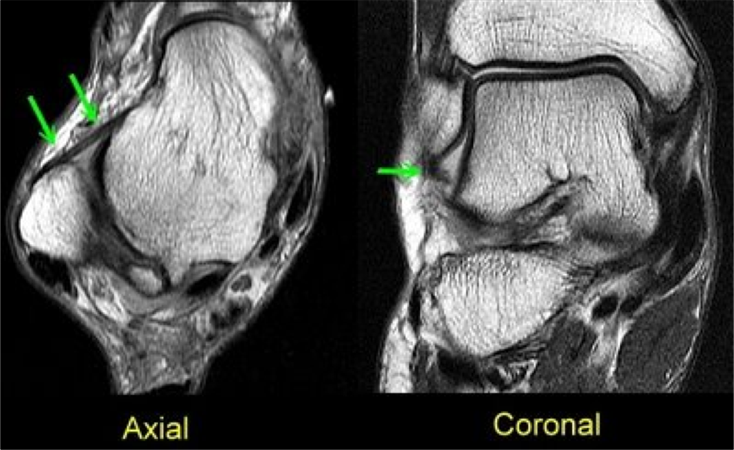 Ankle Ligaments - Foot & Ankle - Orthobullets