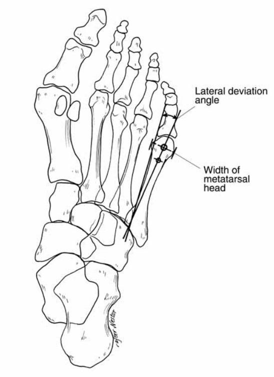 Bunionette Deformity - Foot & Ankle - Orthobullets