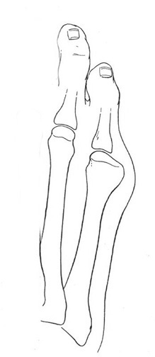 Bunionette Deformity - Foot & Ankle - Orthobullets